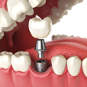 Dental Implant Timeline: Immediate vs. Delayed Implant Loading | Hiossen® Implant