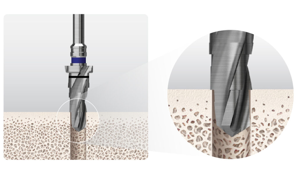 122 Taper Kit - Hiossen® Implant