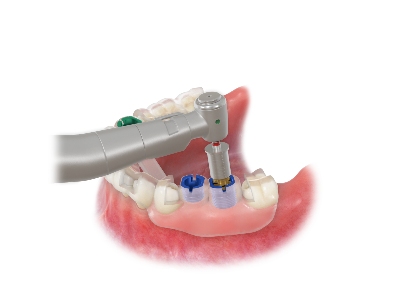 OneGuide - Hiossen® Implant