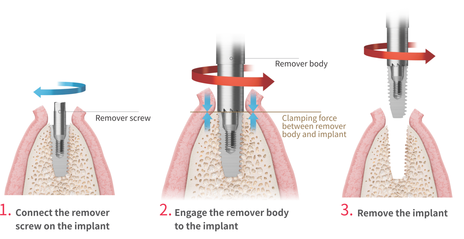 EIR Kit - Hiossen® Implant