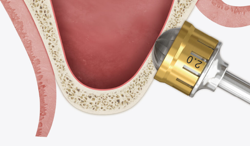 LAS Kit - Hiossen® Implant