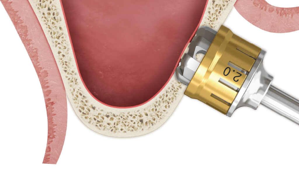 LAS Kit - Hiossen® Implant