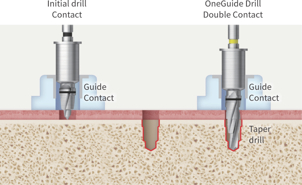 OneGuide - Hiossen® Implant