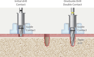 OneGuide - Hiossen® Implant