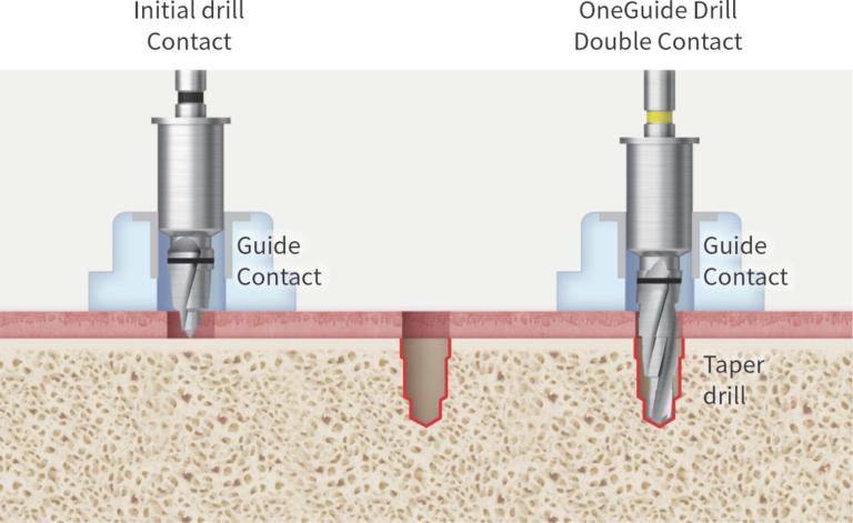 OneGuide - Hiossen® Implant