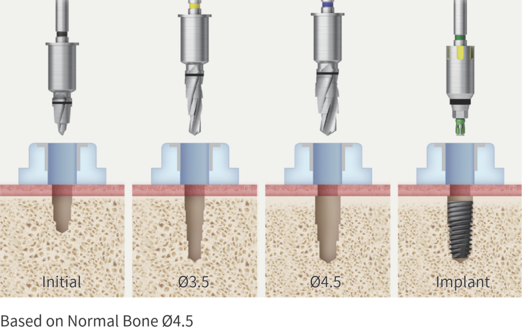 OneGuide - Hiossen® Implant
