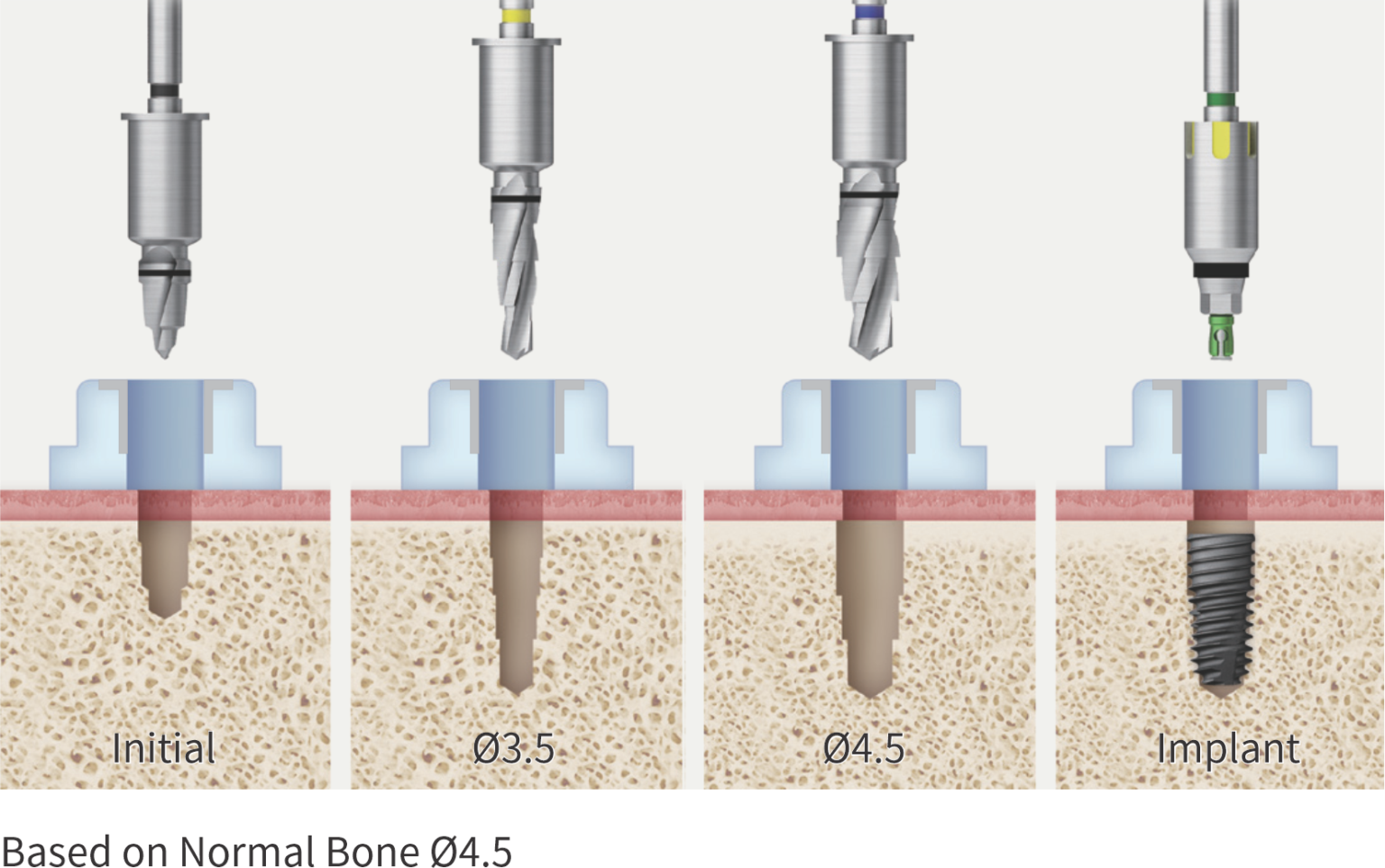 OneGuide - Hiossen® Implant