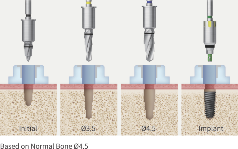 OneGuide - Hiossen® Implant
