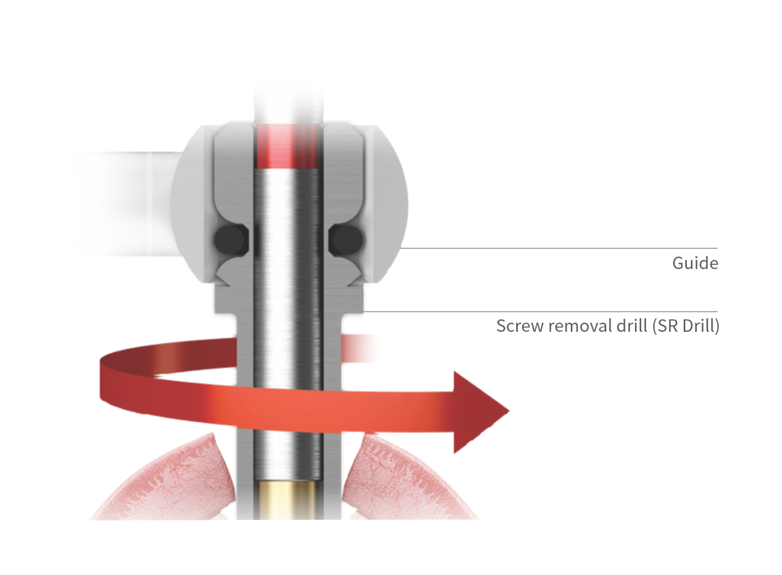 ESR Kit - Hiossen® Implant