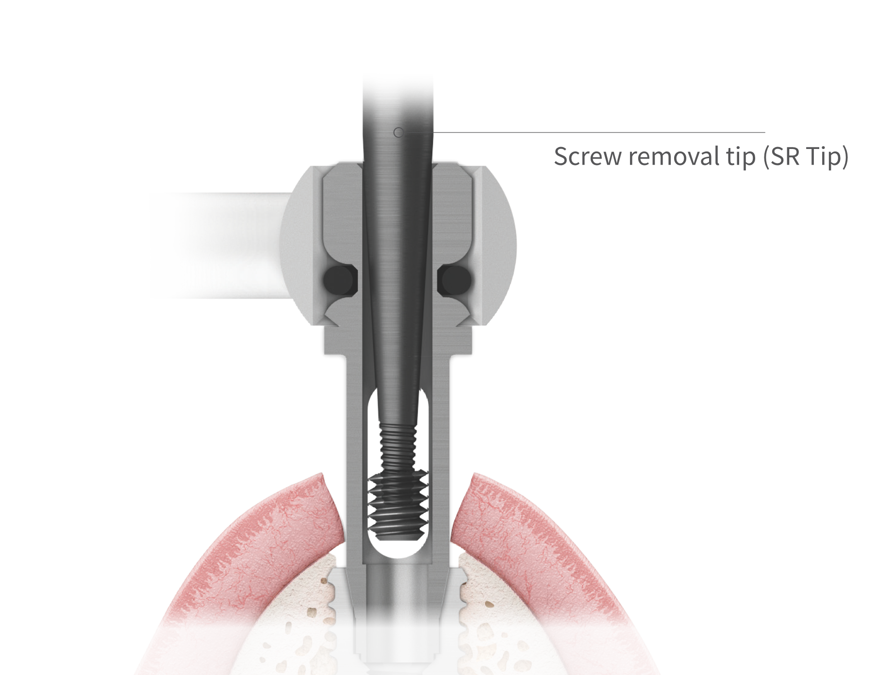 ESR Kit - Hiossen® Implant