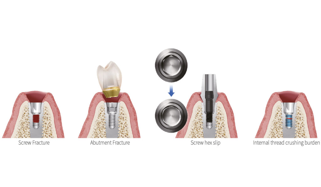 ESR Kit - Hiossen® Implant