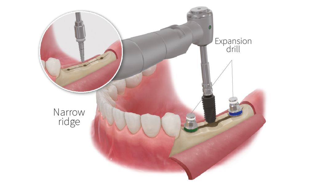 Esset Kit - Hiossen® Implant