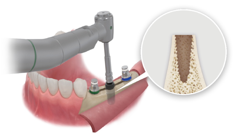 Esset Kit - Hiossen® Implant