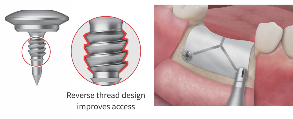 GBR Kit - Hiossen® Implant
