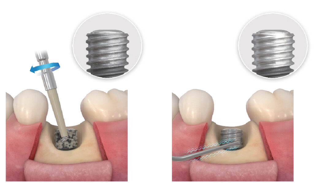 IM Cure Kit - Hiossen® Implant