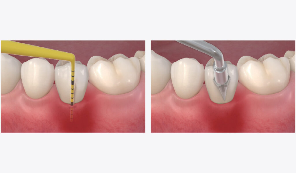 IM Cure Kit - Hiossen® Implant