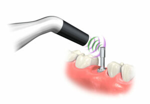 ISQ Monitor - Hiossen® Implant