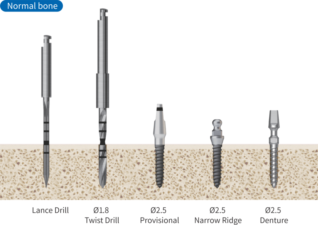EM Kit - Hiossen® Implant
