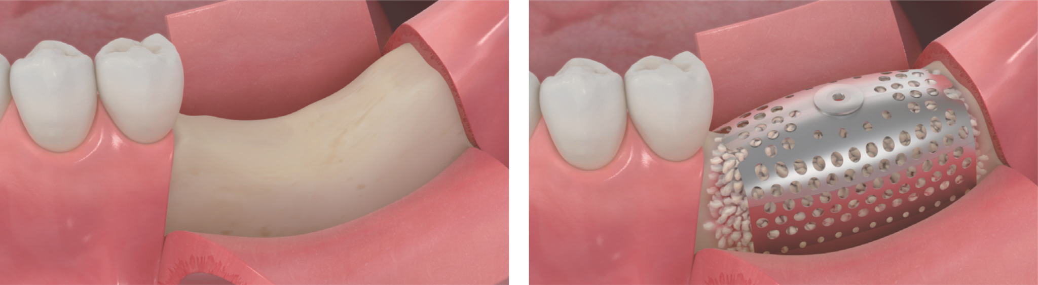 OssBuilder Kit - Hiossen® Implant