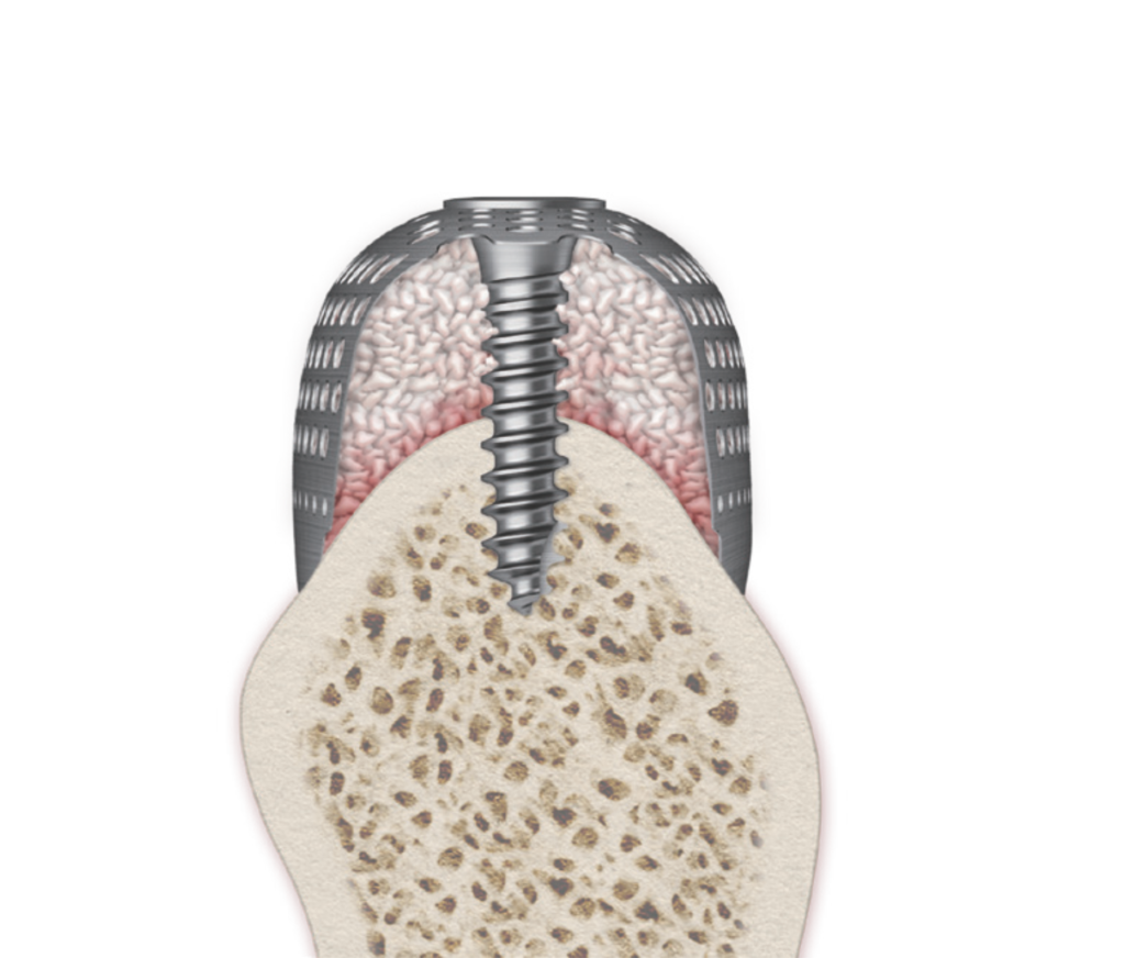 OssBuilder Kit - Hiossen® Implant