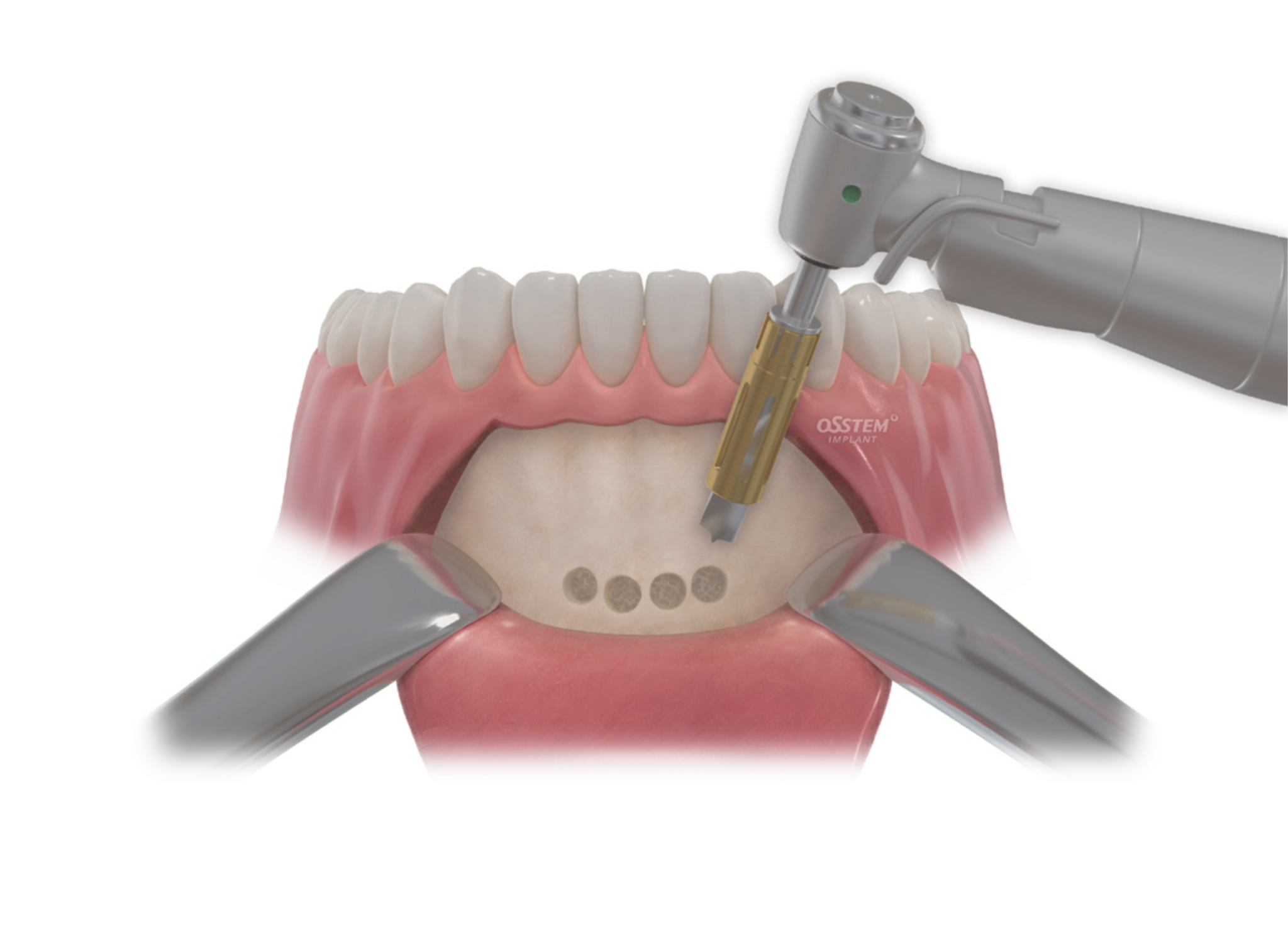 OssBuilder Kit - Hiossen® Implant