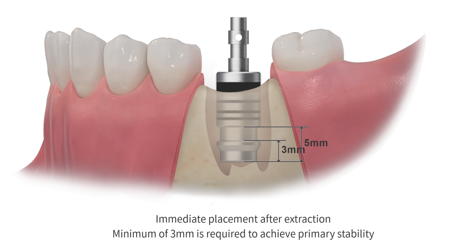 Taper Ultra Kit - Hiossen® Implant