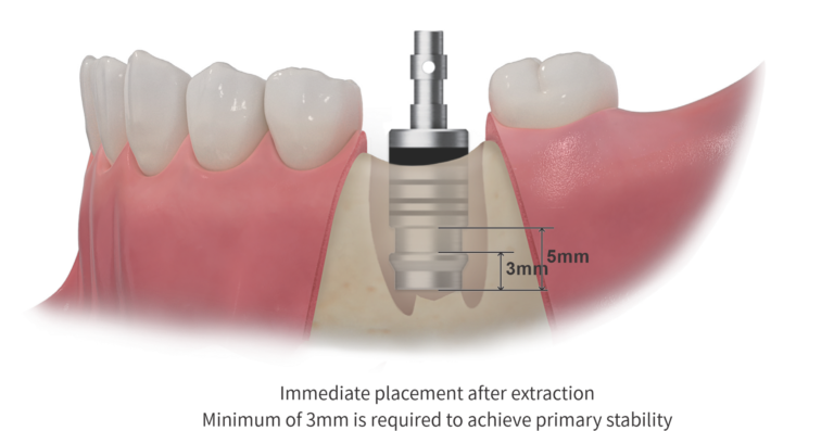 Taper Ultra Kit - Hiossen® Implant