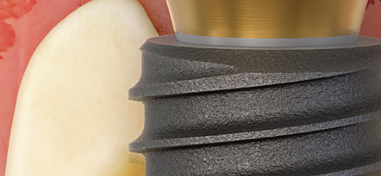 EK Implant System - Hiossen® Implant