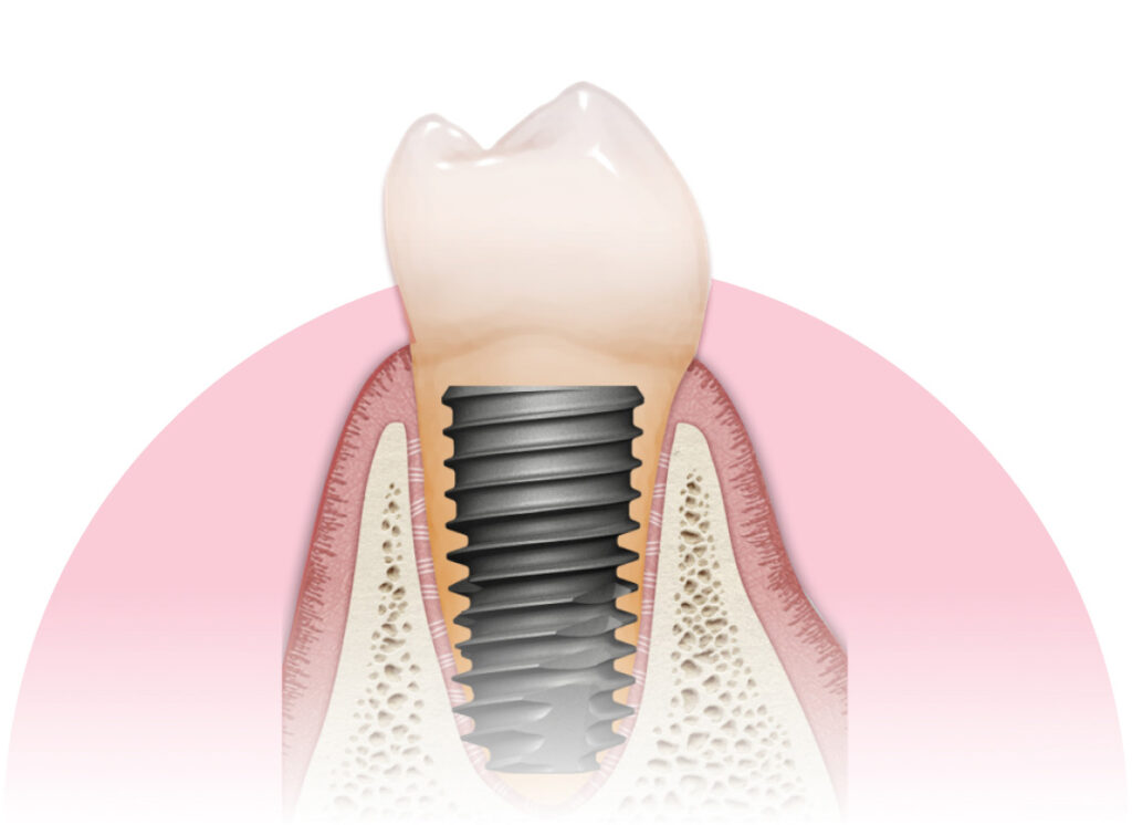 Hiossen® Implant