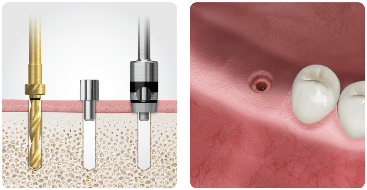ET NH Implant System - Hiossen® Implant