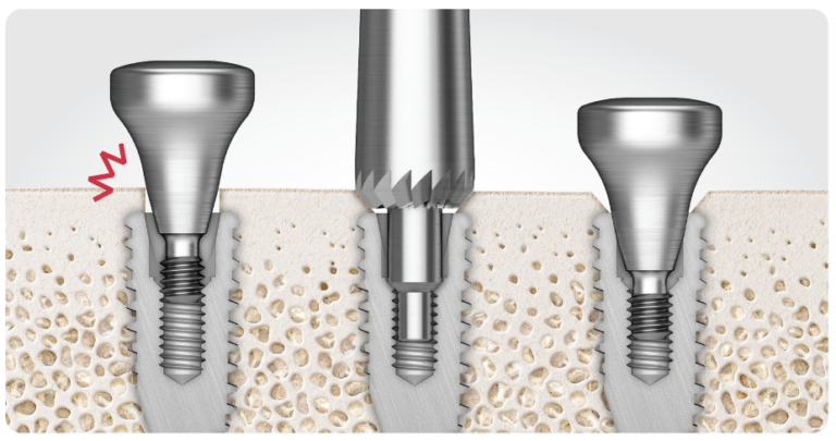 Bone Compaction Kit - Hiossen® Implant