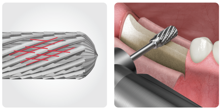 FireCR - Hiossen® Implant